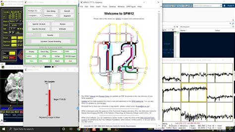 Realignment And Framewise Displacement SPM MATLAB Resting State