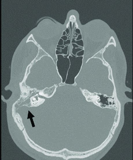 Computed Tomography Showing Obliteration Of The Mastoid And Tympanic