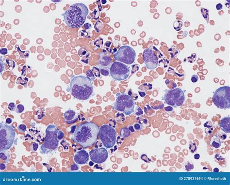 B Cell Lymphoma In Pleural Fluid Stock Photo Image Of Fluid Tumor