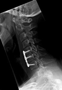 ACDF Watkins Spine