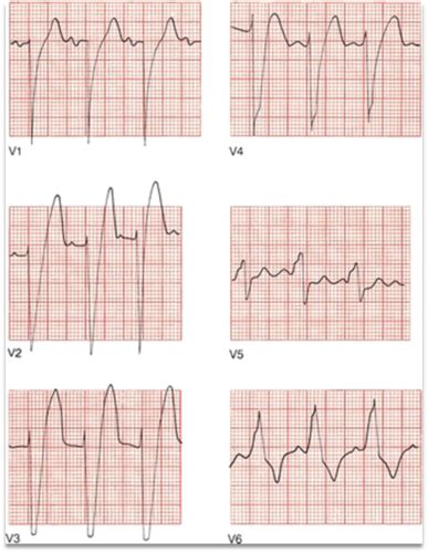 Cardiology Exam 1 Arrhythmias Flashcards Quizlet