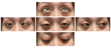 Ophthalmology Dx Double Vision After Collision Ophthalmology Advisor
