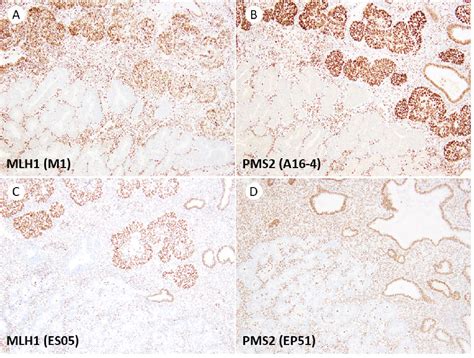 Figure 2 From Mismatch Repair Protein Expression In Endometrial Cancer