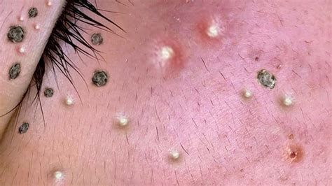 10 أطعمة تساعد على منع ظهور الرؤوس السوداء Srk C148 Youtube