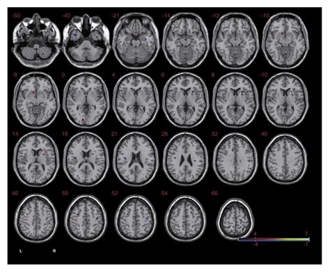 Effect Of Week Pudendal Nerve Stimulation In The Four Clinically Download Scientific Diagram