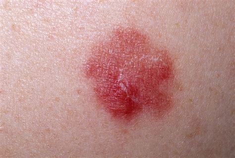 Skin Manifestations Of Chronic Hepatitis C Virus Infection