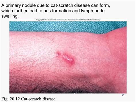 Defenses Cardiovascular System Lymphatic System Protection Ppt Video