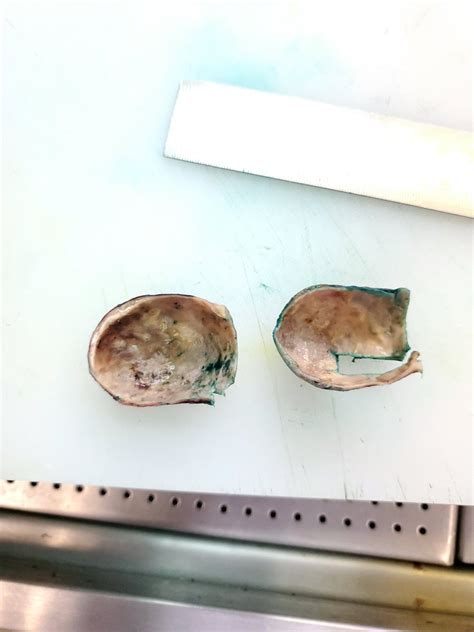 Jerad Gardner Md On Twitter Rt William28538949 Elderly Gall