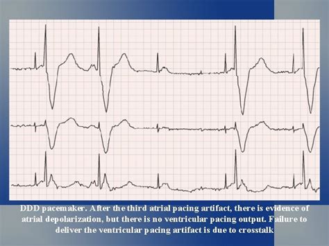 Pacemaker Malfunction ECG Signs Of Pacemaker Malfunction Failure