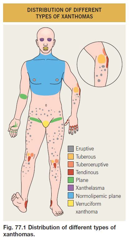 Xanthoma