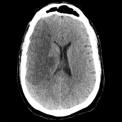 Safety And Efficacy Of Fluoxetine On Functional Outcome After Acute Stroke Affinity