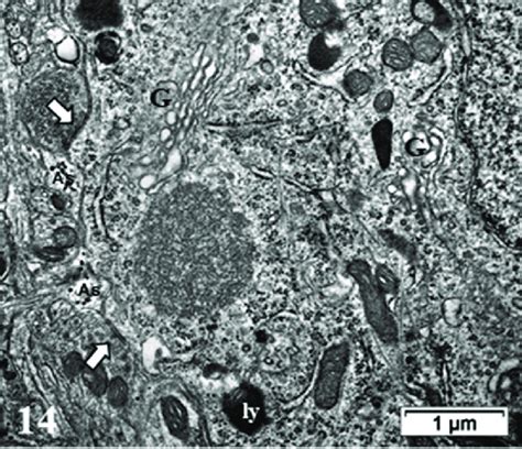Tem Aspect Of The Enlarged Neuron Perikaryon Of Figure 11a With Many