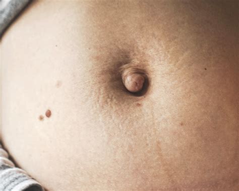 Umbilical Hernia And Belly Button Bulge Singapore Ark Surgical