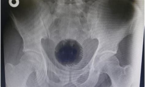 Man 51 Gets Plastic Ball Stuck In His Anus For Two Days Daily Mail Online