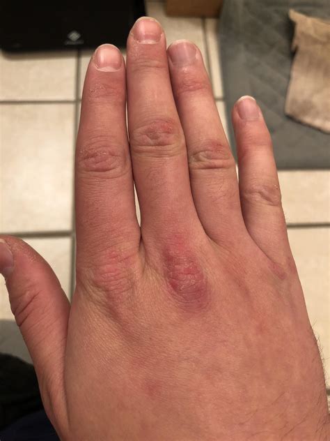 Psoriasis On Knuckles