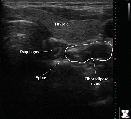 Thyroid Muscle Anatomy Ultrasound