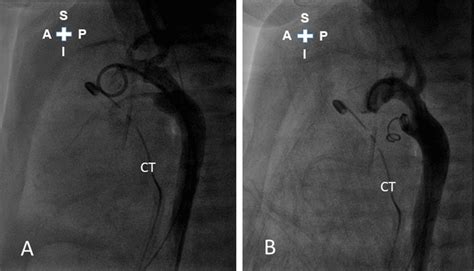 A Lateral View Aortogram Showed A Krichenko Type A1 Patent Ductus