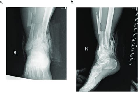 Comminuted Fracture X Ray