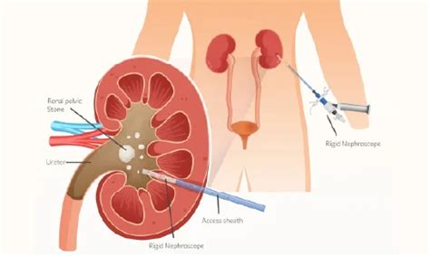 Percutaneous Nephrolithotomy Pcnl In Noida Ck Birla Hospital