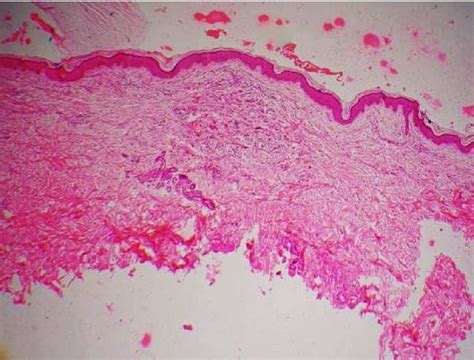 Multinucleated Histiocytes Abutting Connective Tissue With Elastotic