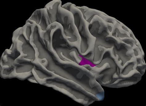 Surface Based Morphometry Analysis Revealed That The Visual