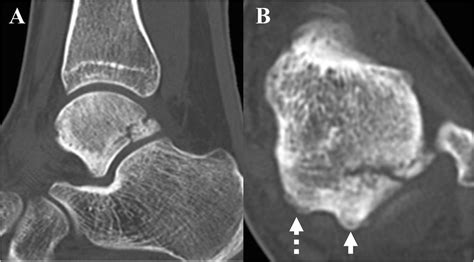Posterior Talar Process Fracture Pacs