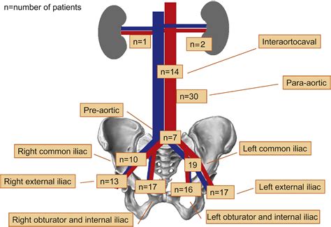 Retroperitoneal Lymph Nodes Epos™