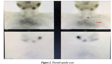The Onset Of Asymptomatic Amiodarone Ind Biomedical Research