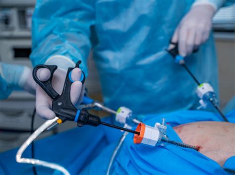 Laparoscopic Appendectomy A Modern Approach To Appendicitis Surgery Saru Hospital