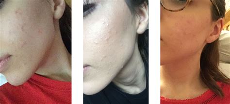 Skincare Routine For Hormonal Chin Acne At Kathy Carter Blog