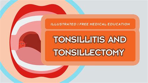 What Is Tonsillitis And Tonsillectomy Youtube