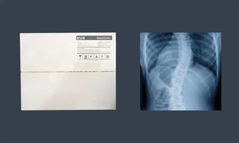 Impact Of Hsin Medical Dry Film On Diagnostic Accuracy Hsin Film