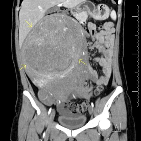 Computed Tomography Scan Displaying A Coronal View Of The Abdomen And