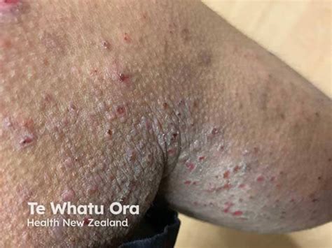 Atopic Dermatitis Skin Of Colour Image