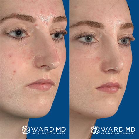 Pin By Irina Ziablova On ринопластика Rhinoplasty Facial Plastic
