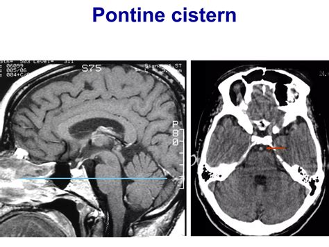 Csf Cisterns Ppt
