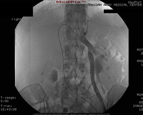 Pelvic Varices Mri
