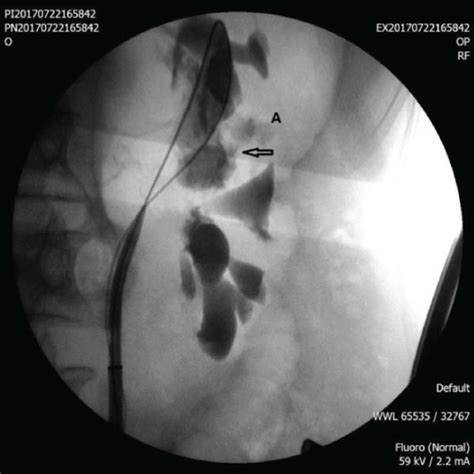 A Stone Containing Calyceal Diverticula Arrow Opacified Neck Of A