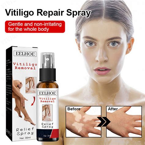 White Spot Repair Essencevitiligo Repair Spray Lazada Ph
