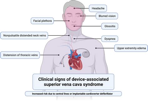 3 cases of superior vena cava syndrome following percutaneous right ventricular assist device