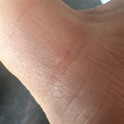 Active Scabies Burrows Rscabies