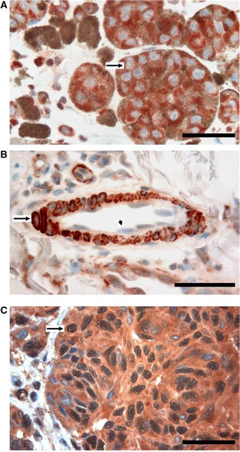 A Immunohistochemical Staining Of Id1 Protein In Human Malignant