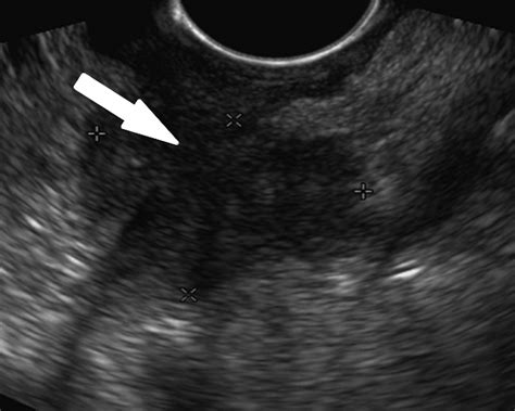 Evaluation Of Imaging Guided Core Biopsy Of Pelvic Masses Ajr
