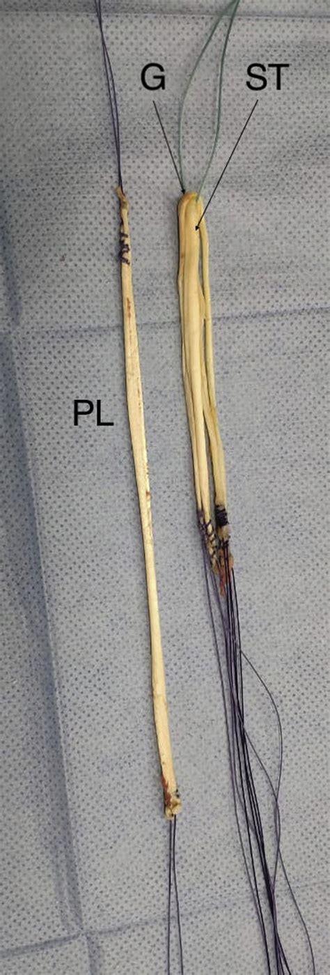The Grafts Are Shown The Hamstrings Gracilis G And Semitendinosus Download Scientific