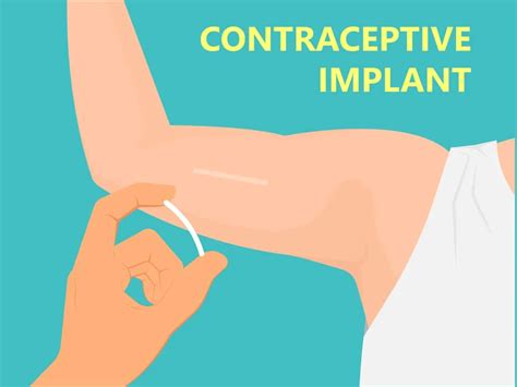 Birth Control Implant In Arm