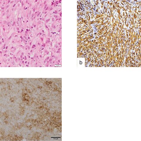 Pathological Findings Of A Left Axillary Lymph Node Biopsy A