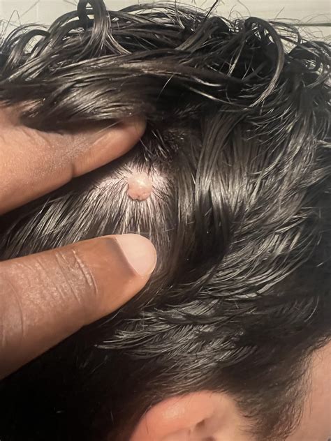 Scalp Wart R Dermatologyquestions
