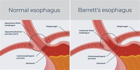 Esophageal Cancer Symptoms Causes Stages Diagnosis And Treatment