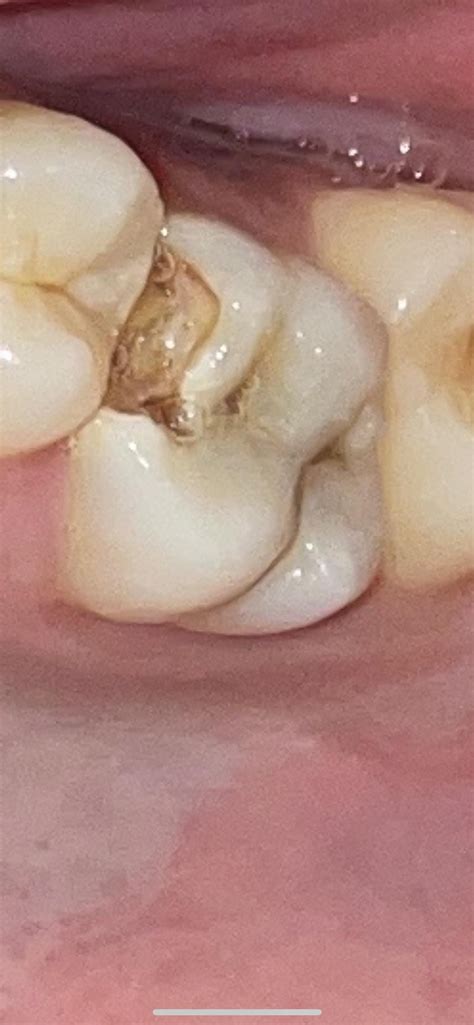 Need Help In Identifying The Problem R Teeth