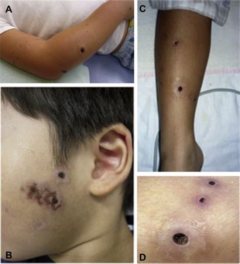 Epstein Barr Virus Skin References In Ampicillin Induced Cutaneous Eruption Associated With